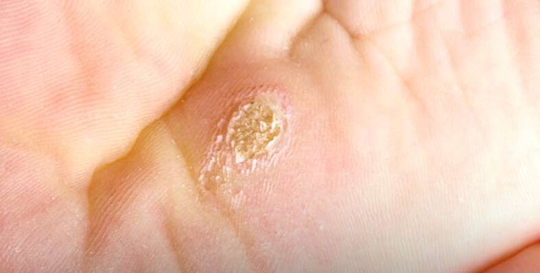 Spikes On The Feet Plantar Warts Causes Symptoms Treatment